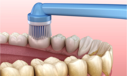 How To Remove Plaque From Your Teeth? (At Home Dental Practices)