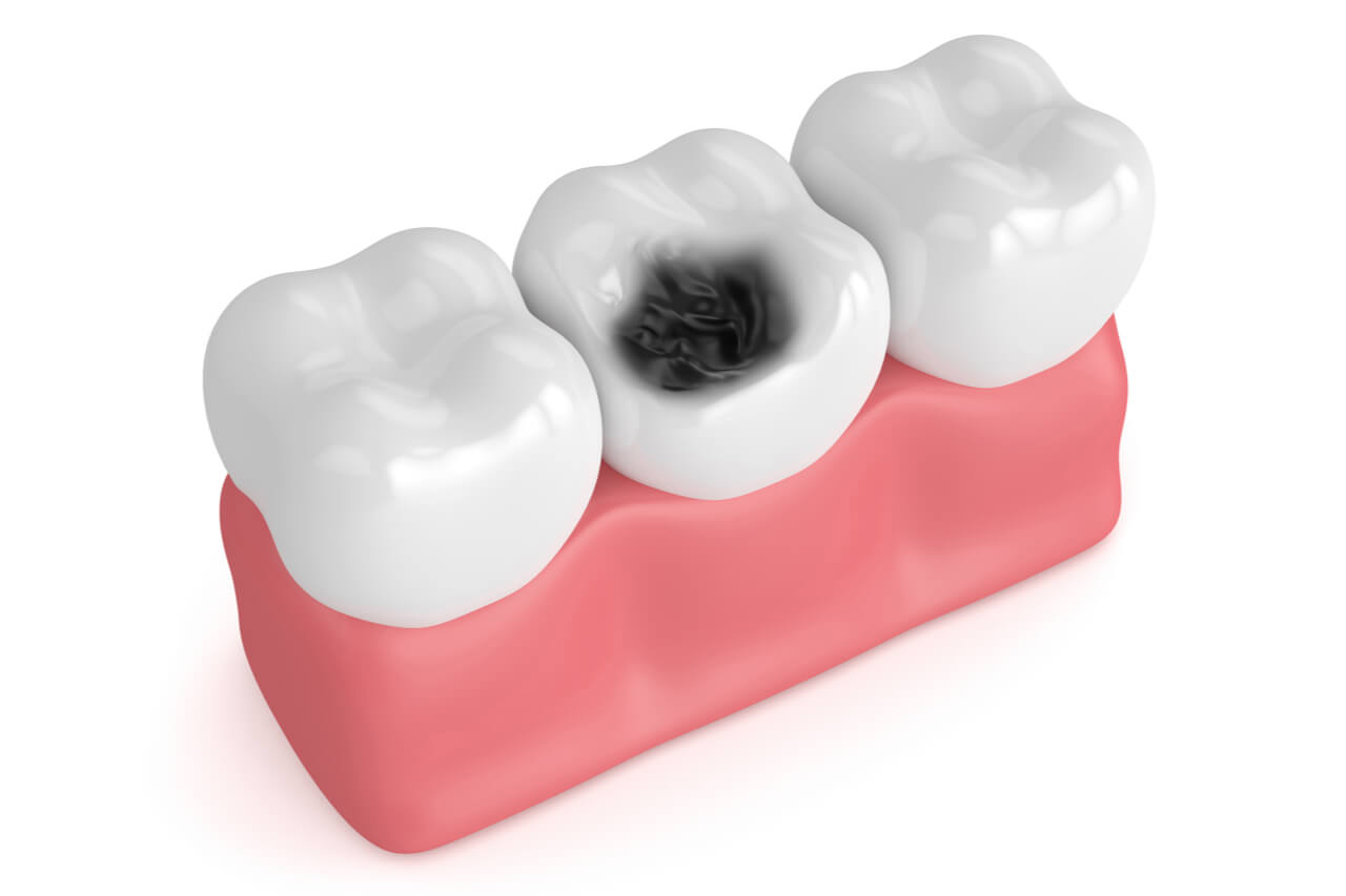 How to Heal Cavities Naturally at Home: Starting with the Basics