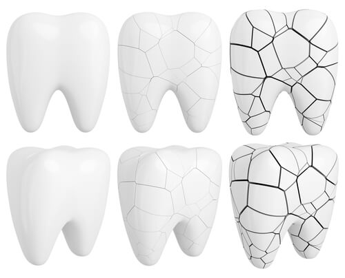 Tooth Decay Black Lines on Teeth: Causes, and Treatment | Trancy